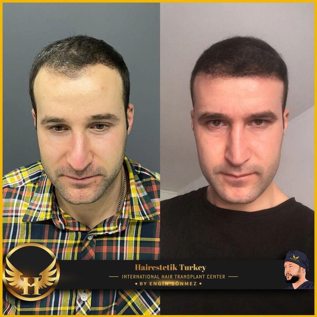 Hairtransplantclinics On Tumblr