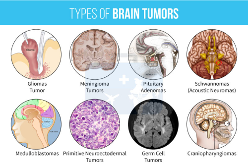 Usmle Step 1 Notes — Brain Tumors