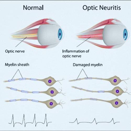 Anonymous Md Findingmedinspiration Optic Neuritis
