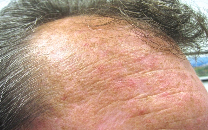 Cloud Tales Actinic Keratosis Causes And Treatment
