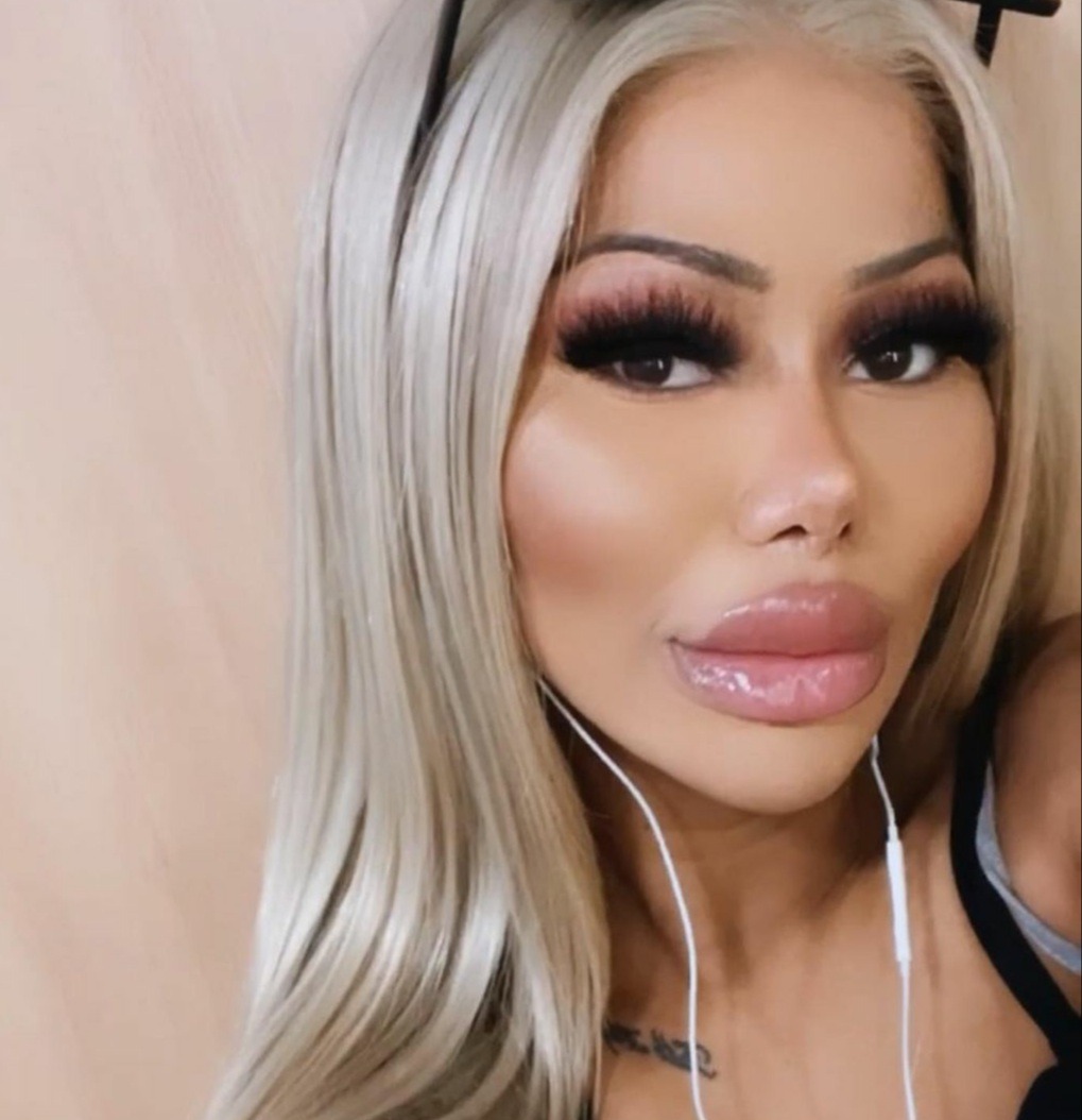 Filler Botox And Plastic On Tumblr Filler