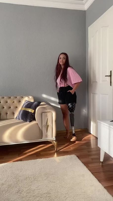 Amputee Legs Stumps And Prostheses — Onelegged Amputee Girl Dances On The Only Leg